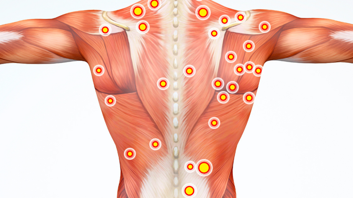 Triggerpoints: Wat zijn het en hoe kun je ze behandelen? - Vitaal Massages